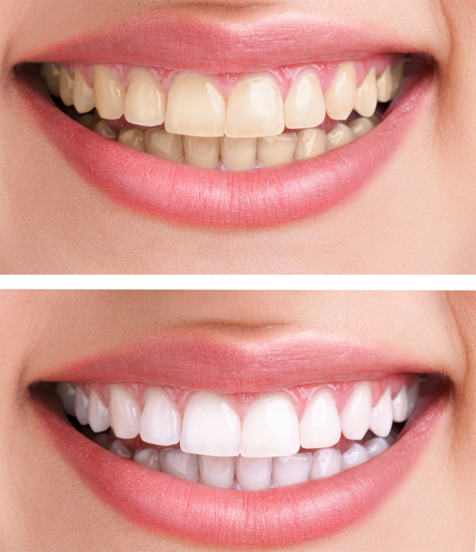 Witte tanden :: Tandartsenpraktijk Quist